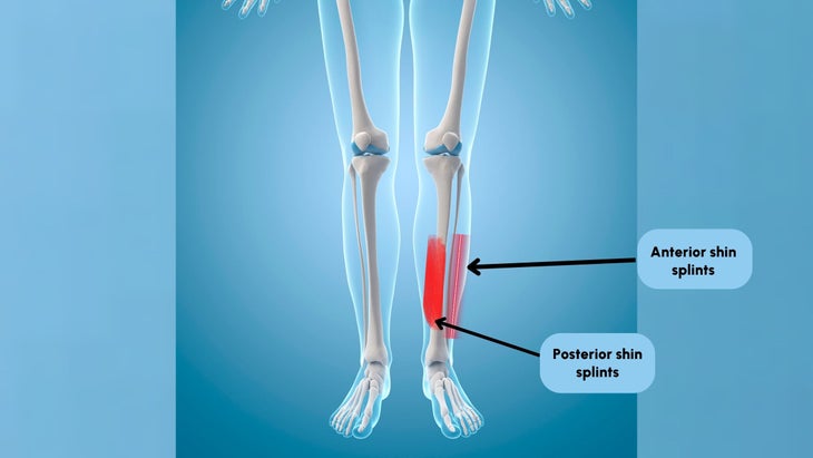 How to Treat Shin Splints