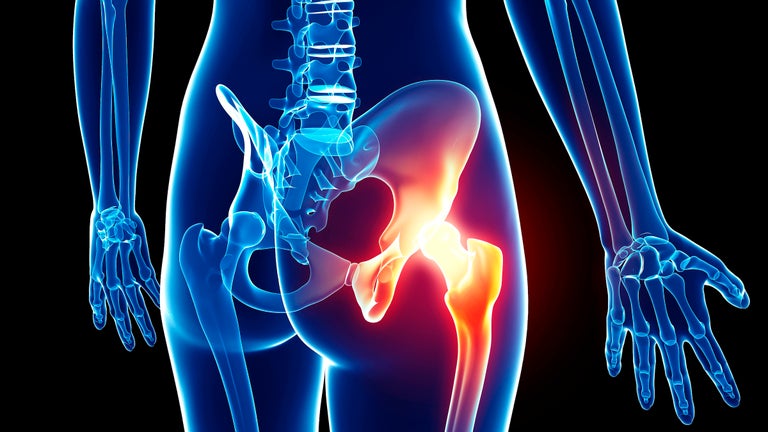 Hip Joint Dysfunction In Runners Causes Solutions And A Return To