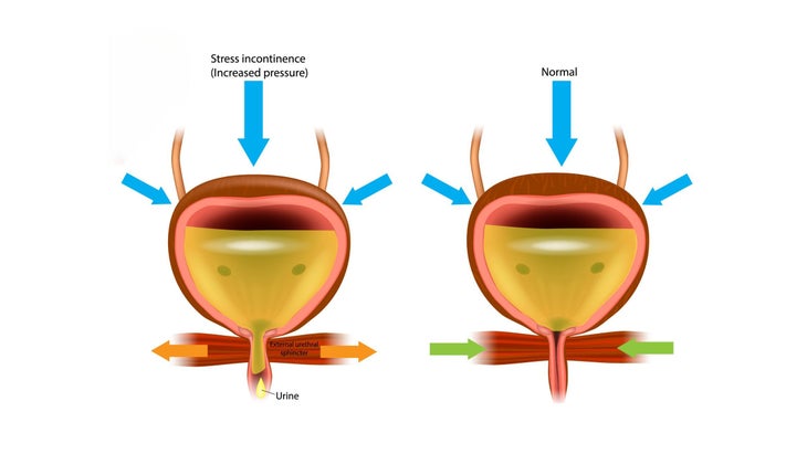 Here's Why You Pee When You Run Fast